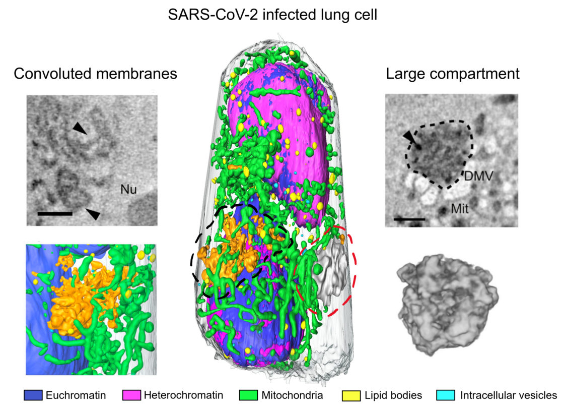 Rapid 3D Visualization of Lung Cells Altered by SARS-CoV-2